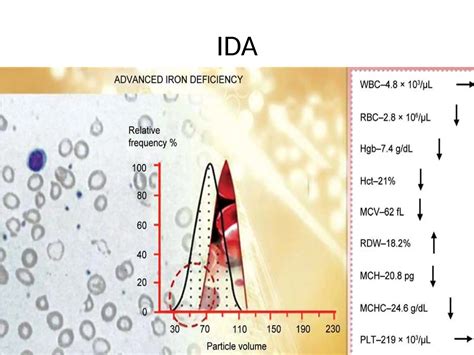 Cbc Principle Of Cell Counter Interpretation Of Histogram
