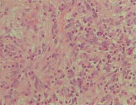 Metastasis Of Sarcoma In The Sternum Oncosurgery