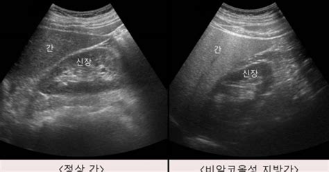 비알코올성 지방간 있으면 대장암·유방암 위험 2배