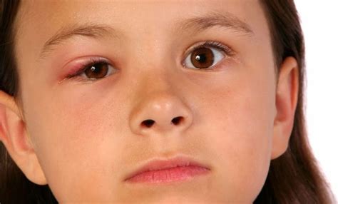 Các Thuốc Trị Lẹo Mắt Cho Trẻ Vinmec