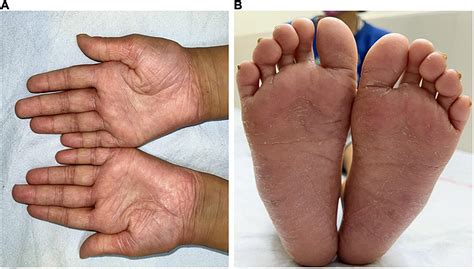 Hand Foot Syndrome Like Eruption Following Mrna Covid 19 Vaccine At