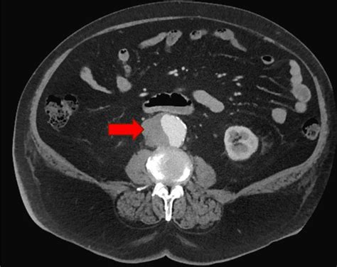 Mycotic Aortic Aneurysm