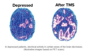 What Is TMS Transcranial Magnetic Stimulation LifeQuality TMS