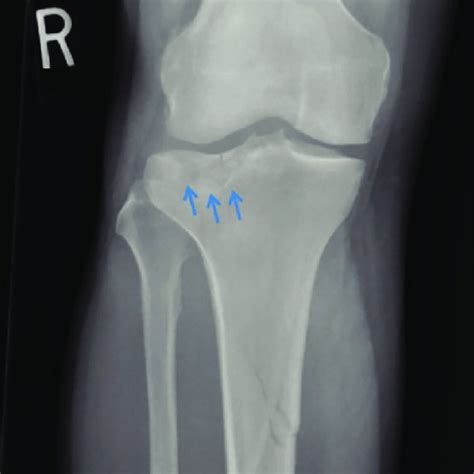X Ray Of Patients Right Leg Showing A Schatzker Type Vi Tibial Plateau Download Scientific
