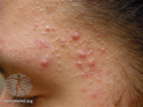 13 Causes Of Red Spots On Skin