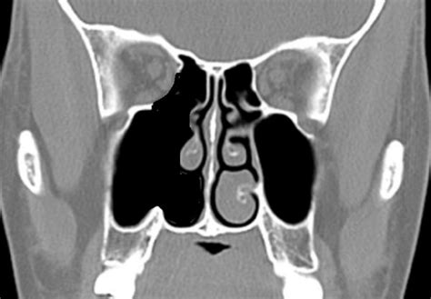 130 Medial Maxillectomy Medicine Libretexts