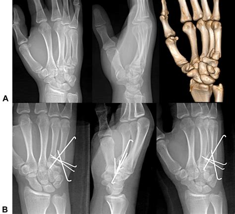 Surgical Outcomes Of Percutaneous Pinning And Open Locking Plating In Patients With Intra