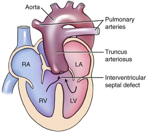 Persistent Truncus Arteriosus Radiology Key