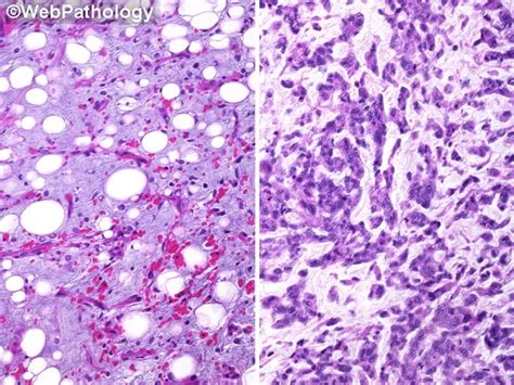 Myxoid Liposarcoma Introduction