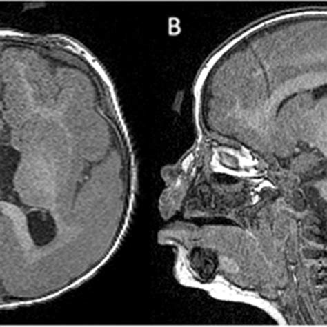 Mri Results A Volumetric T1 Brain Mri Axial And B Sagittal Planes Show Download Scientific