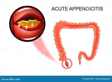 The Inflammation Of The Appendix Stock Vector Illustration Of Medicine Cecum 94081084
