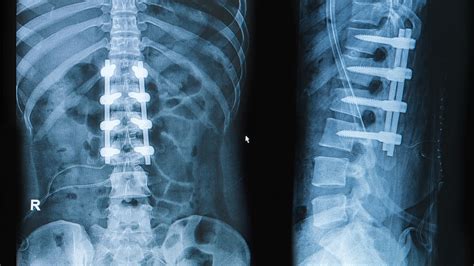Spinal Fusion Complications