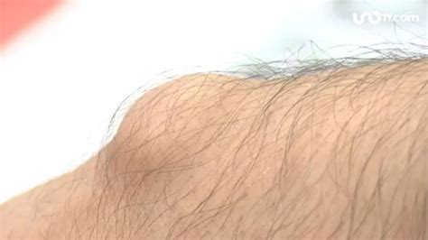 Conoce Qué Es Un Quiste Sinovial Puede Necesitar Atención Médica Unotv