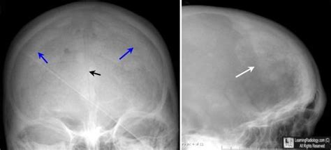 Hyperostosis Frontalis Interna Fissures Of The Skull How To Read