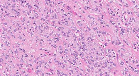 Gastrointestinal Stromal Tumour Of The Stomach Ottawa Atlas Of Pathology