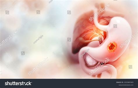 Gastric Cancer Stage：超过 161 张免版税可许可的库存插图与绘画 Shutterstock