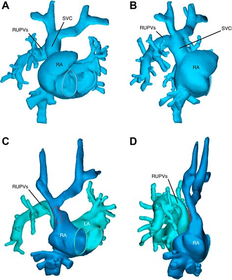 Modified Warden Procedure For Partial Anomalous Pulmonary Venous
