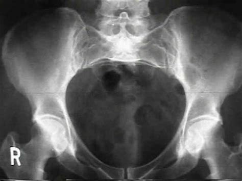 Sacral Insufficiency Fracture Spine Orthobullets