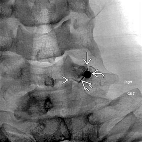 Facet Joint Injection Cervical Spine Clinical Tree