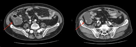 Contrast Enanched Ct Scans Showing The Enlarged Appendix With Download Scientific Diagram