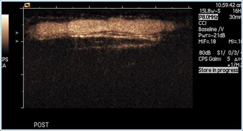 Post Fistuloplasty Appearance On Ceus Arrow With Resolution Of