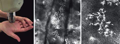 Reflective Confocal Microscopy In Vivo A Examination Being Performed
