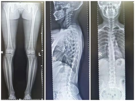 Sistema De Fluoroscopia Gastrointestinal Digital Todo En Uno Imágenes