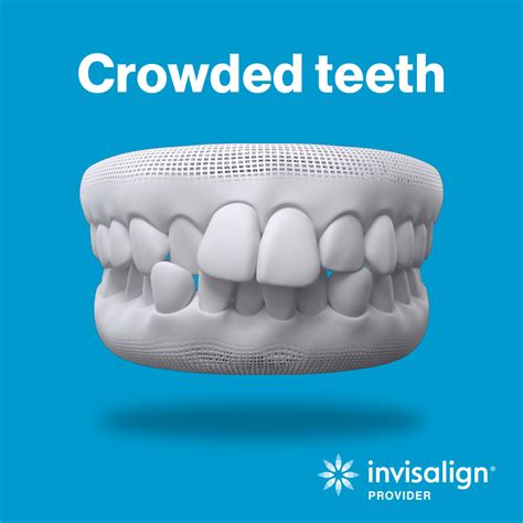 Can Invisalign Fix Crowded Teeth Sloan Creek Dental