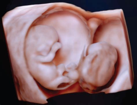 Sonographic Detection Of Fetal Abnormalities Before 11 Weeks Of Gestation Rolnik 2020