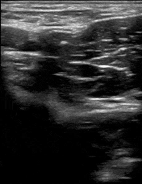 Dvt Ultrasound Made Easy Step By Step Guide Ultrasound Dvt Lower