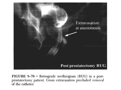 Retrograde Urethrogram Presentation 1 Ppt Pptx Retrograde Urethrogram Presentation 1 Ppt Pptx