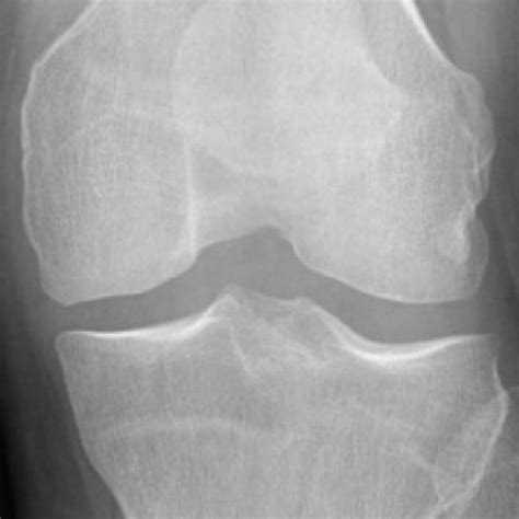 Kneesegmentationv1 Instance Segmentation Dataset V1 2024 07 01 7 26pm By Dotdetection