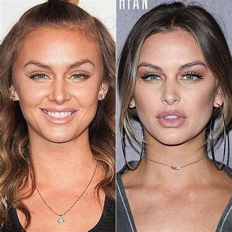 Celebrity Cheek Fillers Before And After 60 Photos Moonagedaydreamfilm