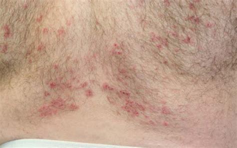 Dermatitis Herpetiformis Scalp