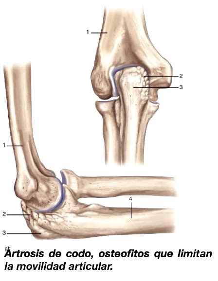 Artrosis De Codo Synergia