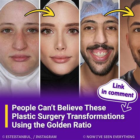 People Cant Believe These Plastic Surgery Transformations Using The