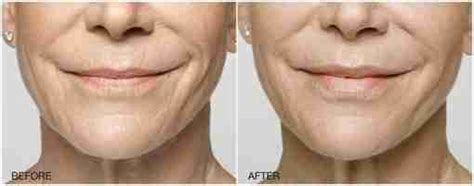 Best Treatment For Frown Lines Erase Cosmetics