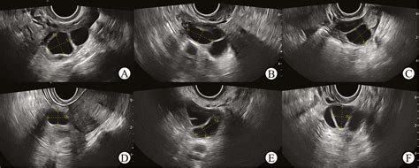 Deep Learning Based Two Dimensional Ultrasound For Follicle Monitoring In Infertility Patients