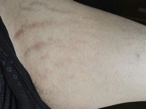 14年以上的妊娠纹用怎么消除？ 孕小帮