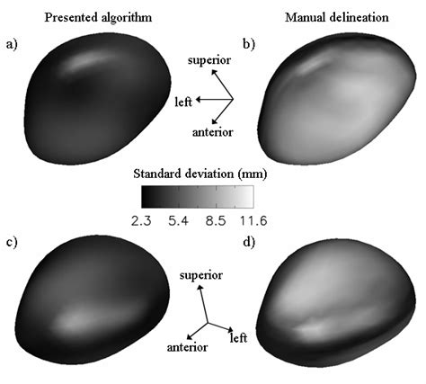 The Observer Variability Over The Delineations Created On The 10 Cbct Download Scientific