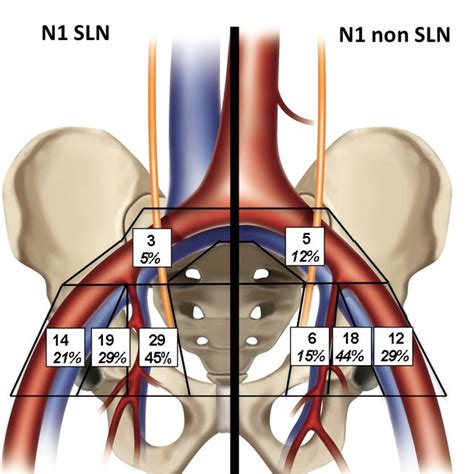 Anatomical Distribution Of Sentinel Lymph Nodes Sln By Download Scientific Diagram