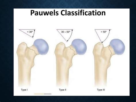 Neck Of Femur Fracture Its Classification And Treatment Ppt