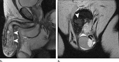Penile Cancer Staging Mri