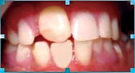 Postoperative View After Removable Partial Denture Insertion Download