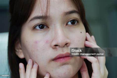 여드름과 피부 얼굴에 흉터 피지선의 장애 십대 소녀 스킨 케어 미용 문제 20 24세에 대한 스톡 사진 및 기타 이미지 20 24세 건강관리와 의술 건강한 생활방식