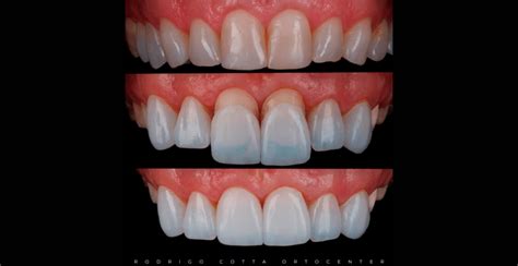 O Que Você Precisa Saber Sobre Lente De Contato Dental Ortocenter