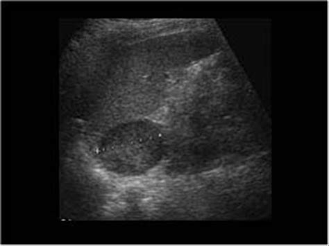 Abdomen And Retroperitoneum 1 10 Adrenal Glands Case 1 10 2 Adrenal Adenomas Ultrasound Cases