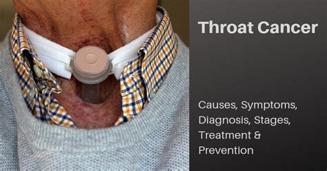 What Is Throat Cancer Meaning Causes Symptoms Complications Stages Prevention And