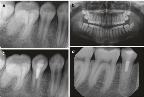 Revascularization Endodontic Prognosis Clinical Guide For Optimal Treatment Outcome