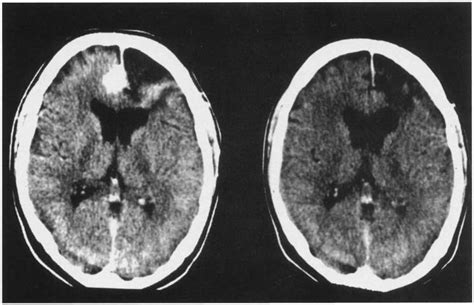Contrast Enhanced Ct Scans Before Left And After Right 2 Cycles Of